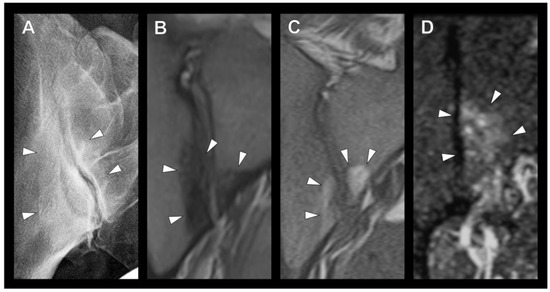 Clustered Occurrence of Osteitis Condensans Ilii in Patients with ...