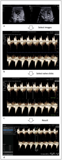 How Automated Techniques Ease Functional Assessment of the Fetal Heart ...