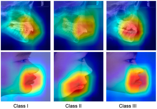Automated Sagittal Skeletal Classification of Children Based on Deep Learning
