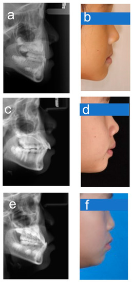 Automated Sagittal Skeletal Classification of Children Based on Deep ...