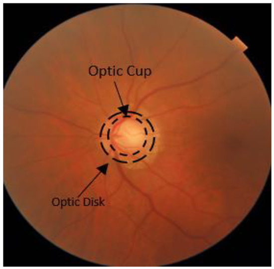 Automatic Diagnosis of Glaucoma from Retinal Images Using Deep Learning ...