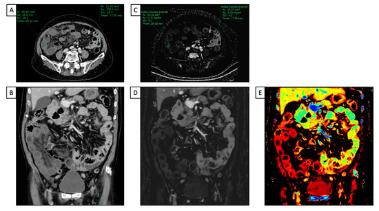 Principles and Applications of Dual-Layer Spectral CT in ...