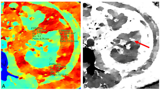 Minimal Fat Content in Papillary Renal Cell Carcinoma Diagnosed with ...