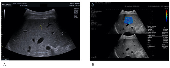 Correlation between a New Point-Shear Wave Elastography Device (X+pSWE ...