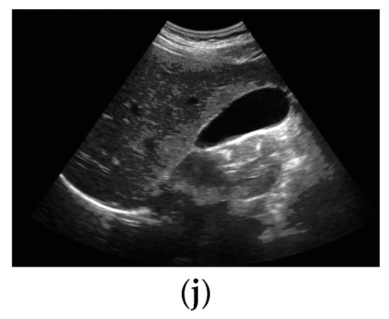 Detection of Gallbladder Disease Types Using Deep Learning: An ...