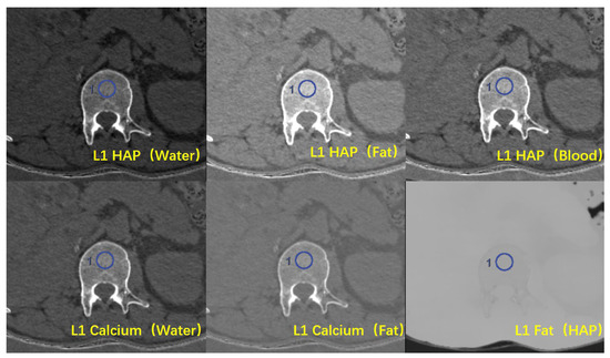 Diagnostics | Free Full-Text | Diagnostic Accuracy of Dual-Energy CT ...