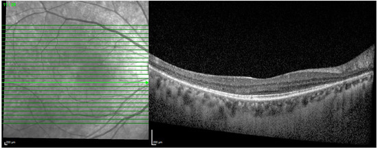 Review of Retinal Imaging Modalities for Hydroxychloroquine Retinopathy