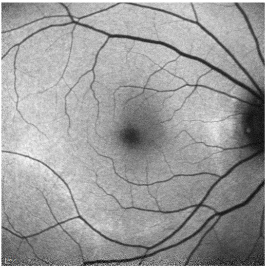 Review of Retinal Imaging Modalities for Hydroxychloroquine Retinopathy