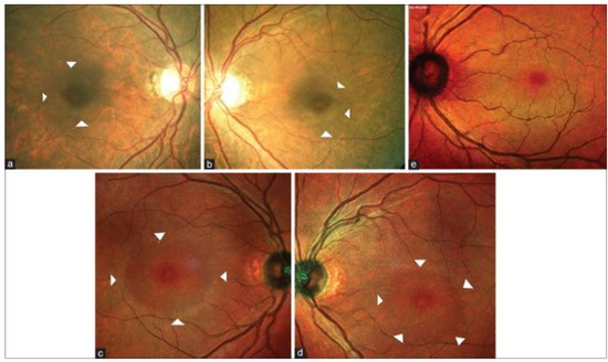 Diagnostics | Free Full-Text | Review of Retinal Imaging Modalities for ...