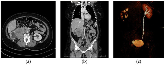 Inferior Vena Cava (IVC) Resections without Reconstruction in Renal ...
