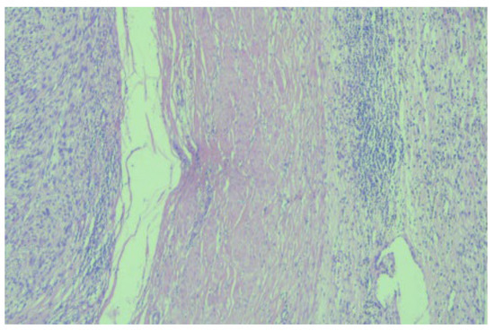 Inferior Vena Cava (IVC) Resections without Reconstruction in Renal ...