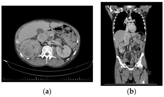 Inferior Vena Cava (IVC) Resections without Reconstruction in Renal ...