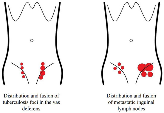 The Role of Contrast-Enhanced Ultrasound in the Differential Diagnosis of Tuberous Vas Deferens ...