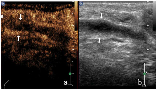 The Role of Contrast-Enhanced Ultrasound in the Differential Diagnosis ...