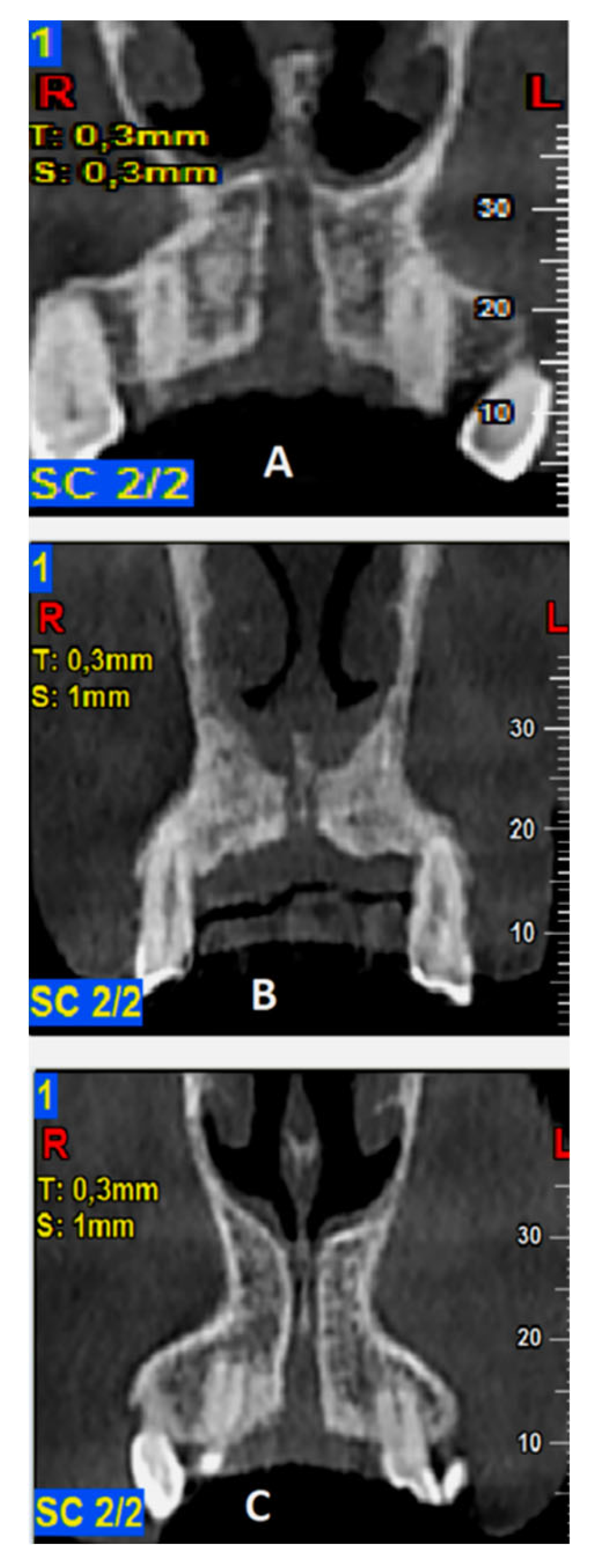 Morphological Assessment of Nasopalatine Canal Using Cone Beam Computed Tomography: A ...