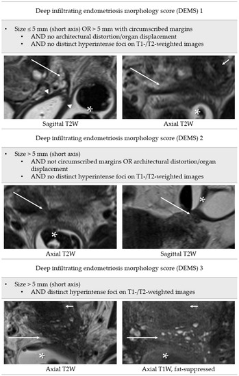 Deep Infiltrating Endometriosis: Diagnostic Accuracy of Preoperative ...