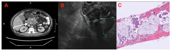 Approach to Pancreatic Head Mass in the Background of Chronic Pancreatitis