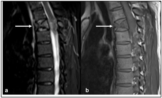 Primary Osseous Malignancies of the Spine