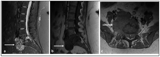 Primary Osseous Malignancies of the Spine