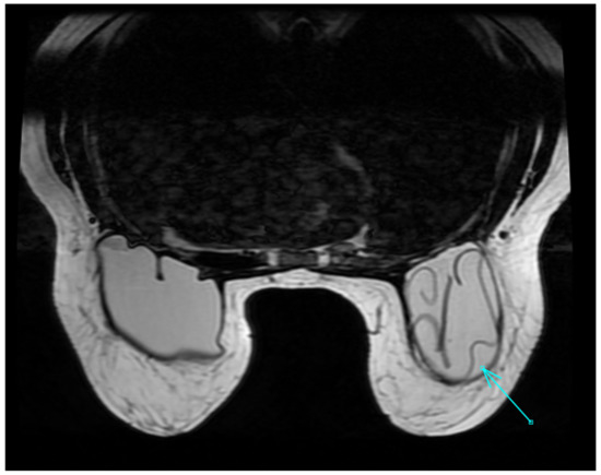 Medical Imaging of Inflammations and Infections of Breast Implants