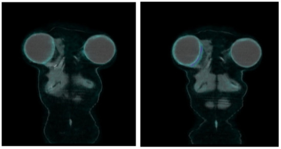 Medical Imaging of Inflammations and Infections of Breast Implants