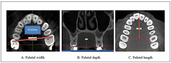 Three-Dimensional Measurements of the Palate and Dental Arch Perimeter ...