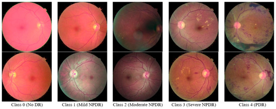 A Hybrid Technique for Diabetic Retinopathy Detection Based on Ensemble-Optimized CNN and ...
