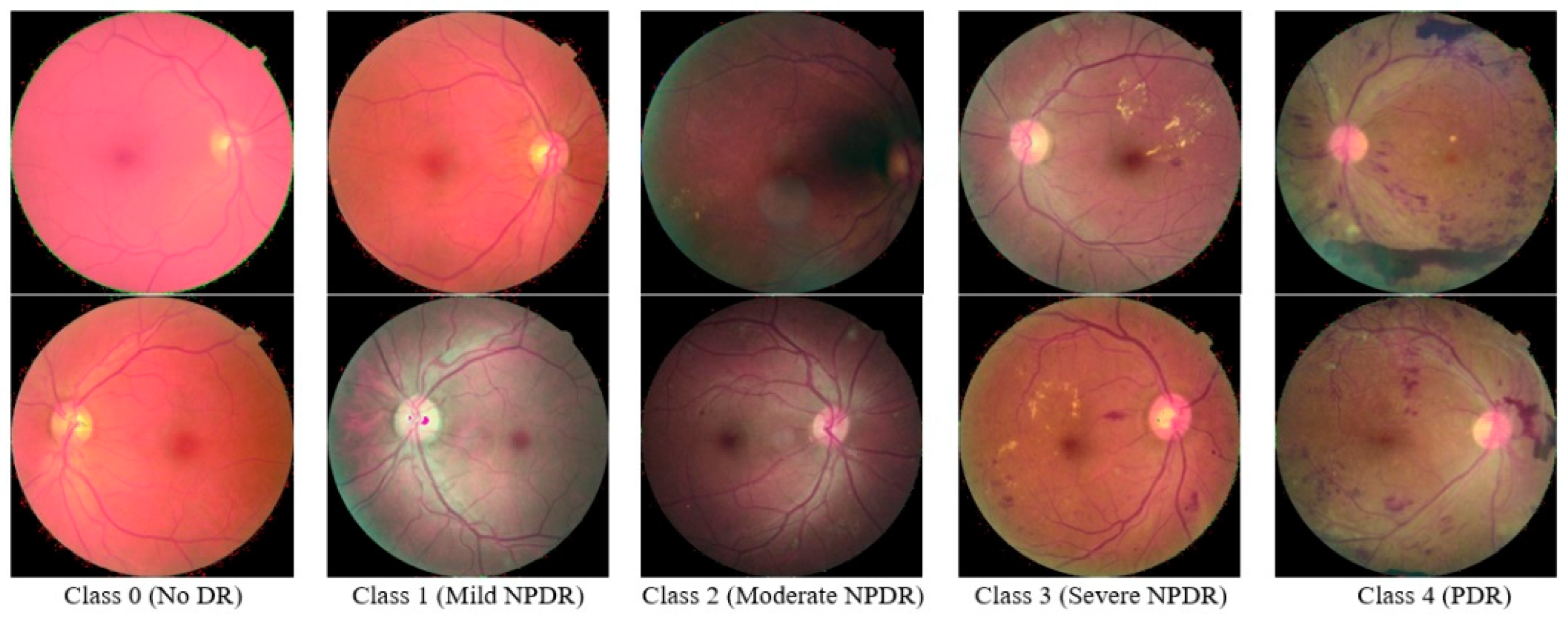 A Hybrid Technique for Diabetic Retinopathy Detection Based on Ensemble-Optimized CNN and ...