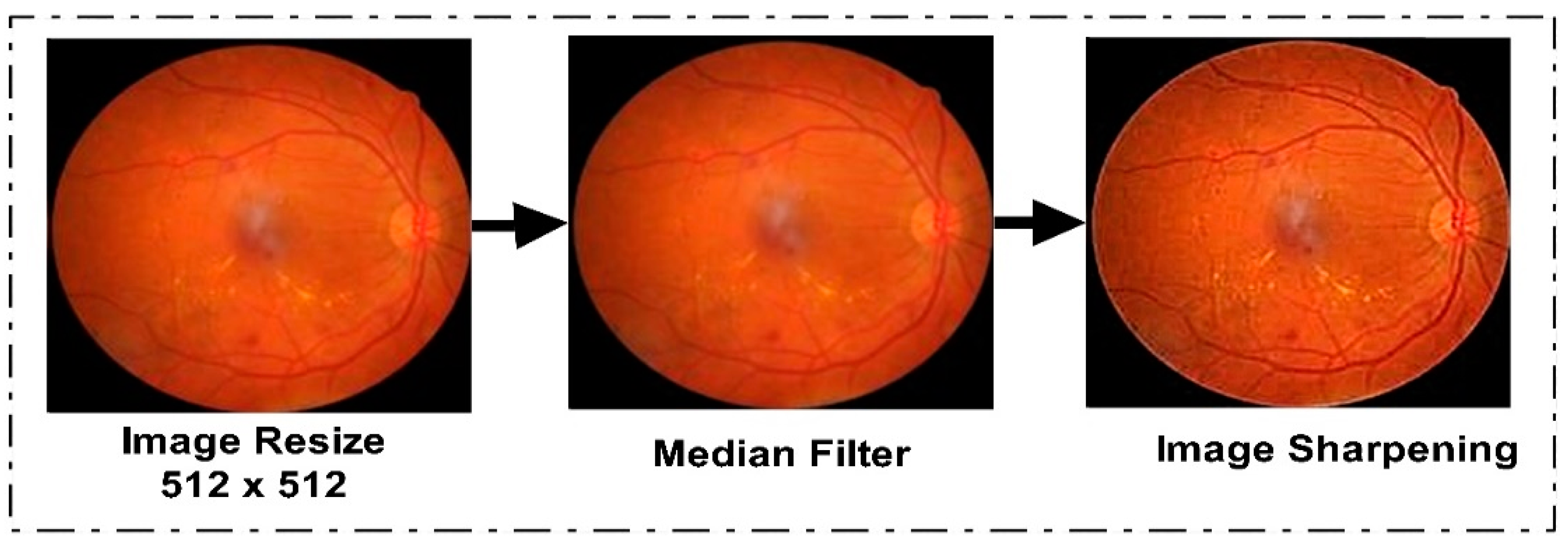 A Hybrid Technique for Diabetic Retinopathy Detection Based on Ensemble-Optimized CNN and ...