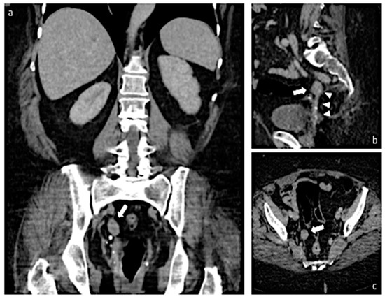 Conservative Management and Ultrasound Follow-Up of Parasitic Myoma ...