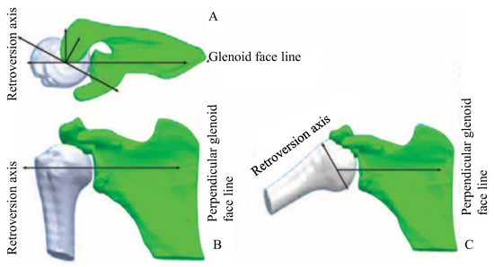 Image-Based Numerical Analysis for Isolated Type II SLAP Lesions in ...