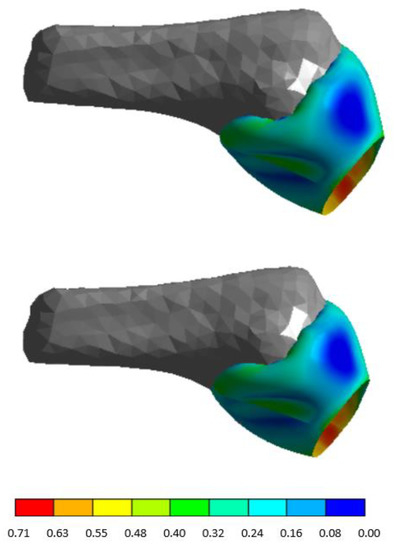 Image-Based Numerical Analysis for Isolated Type II SLAP Lesions in ...