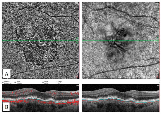Clinical Use of Optical Coherence Tomography Angiography in Retinal ...
