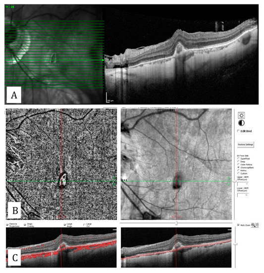 Clinical Use of Optical Coherence Tomography Angiography in Retinal ...