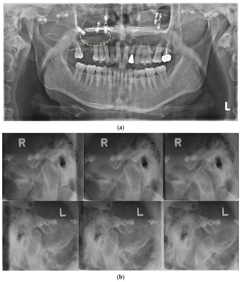 Transoral Marsupialization of an Isolated Surgical Ciliated Cyst of the ...