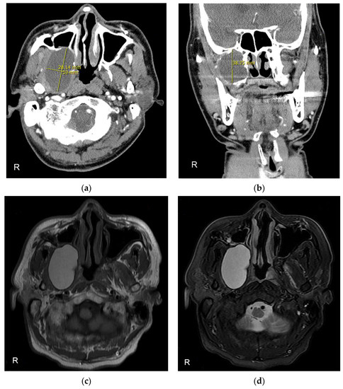 Transoral Marsupialization of an Isolated Surgical Ciliated Cyst of the ...