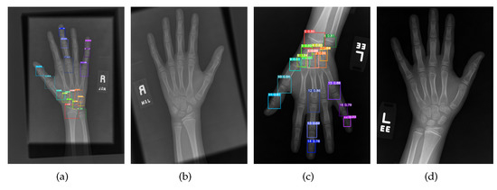 Diagnostics | Free Full-Text | Automated Skeletal Bone Age Assessment with Two-Stage ...