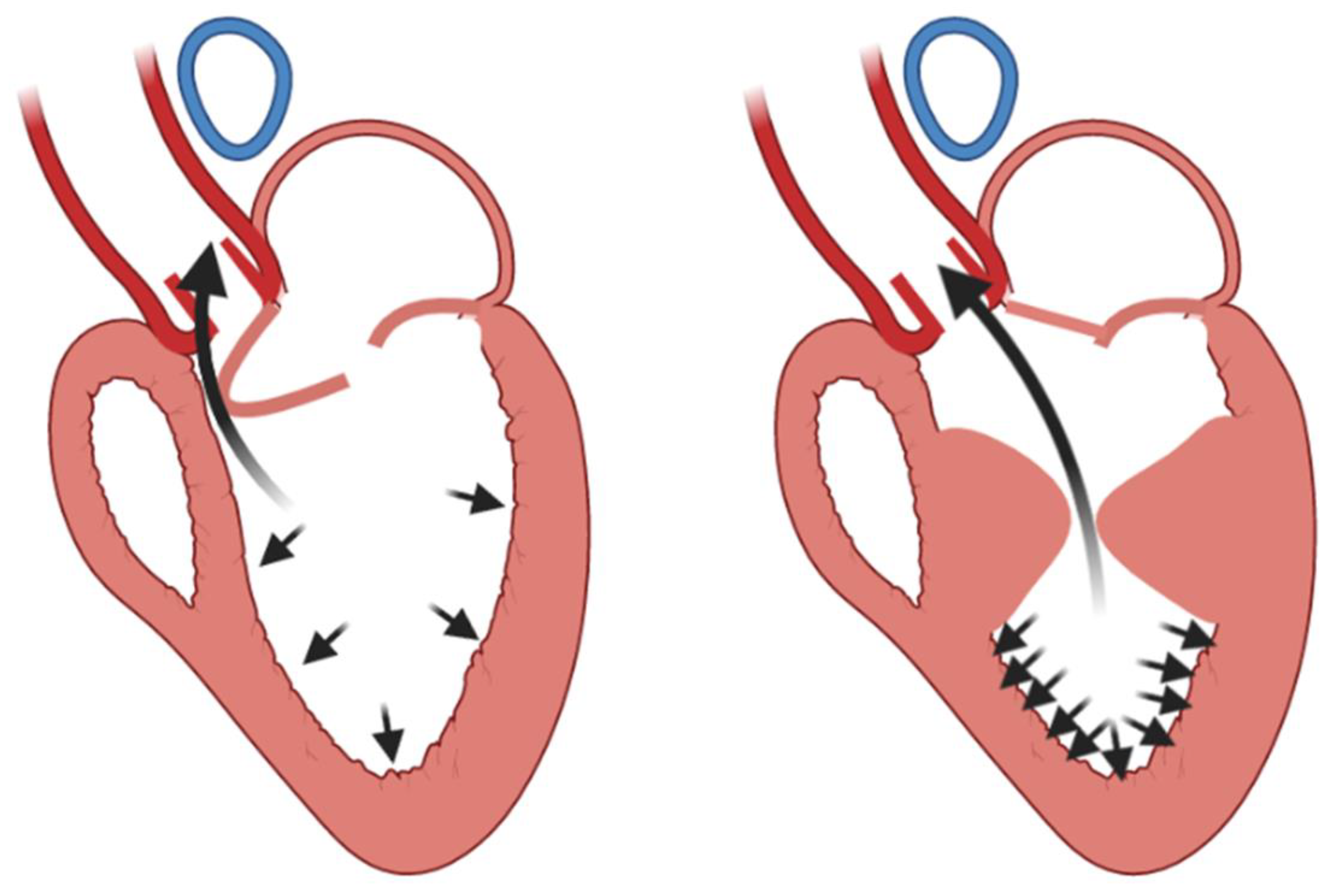 Diagnostics | Free Full-Text | Diagnosis and Clinical Implication of Left Ventricular Aneurysm ...