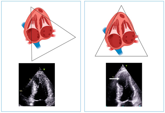 Diagnostics | Free Full-Text | Diagnosis and Clinical Implication of Left Ventricular Aneurysm ...