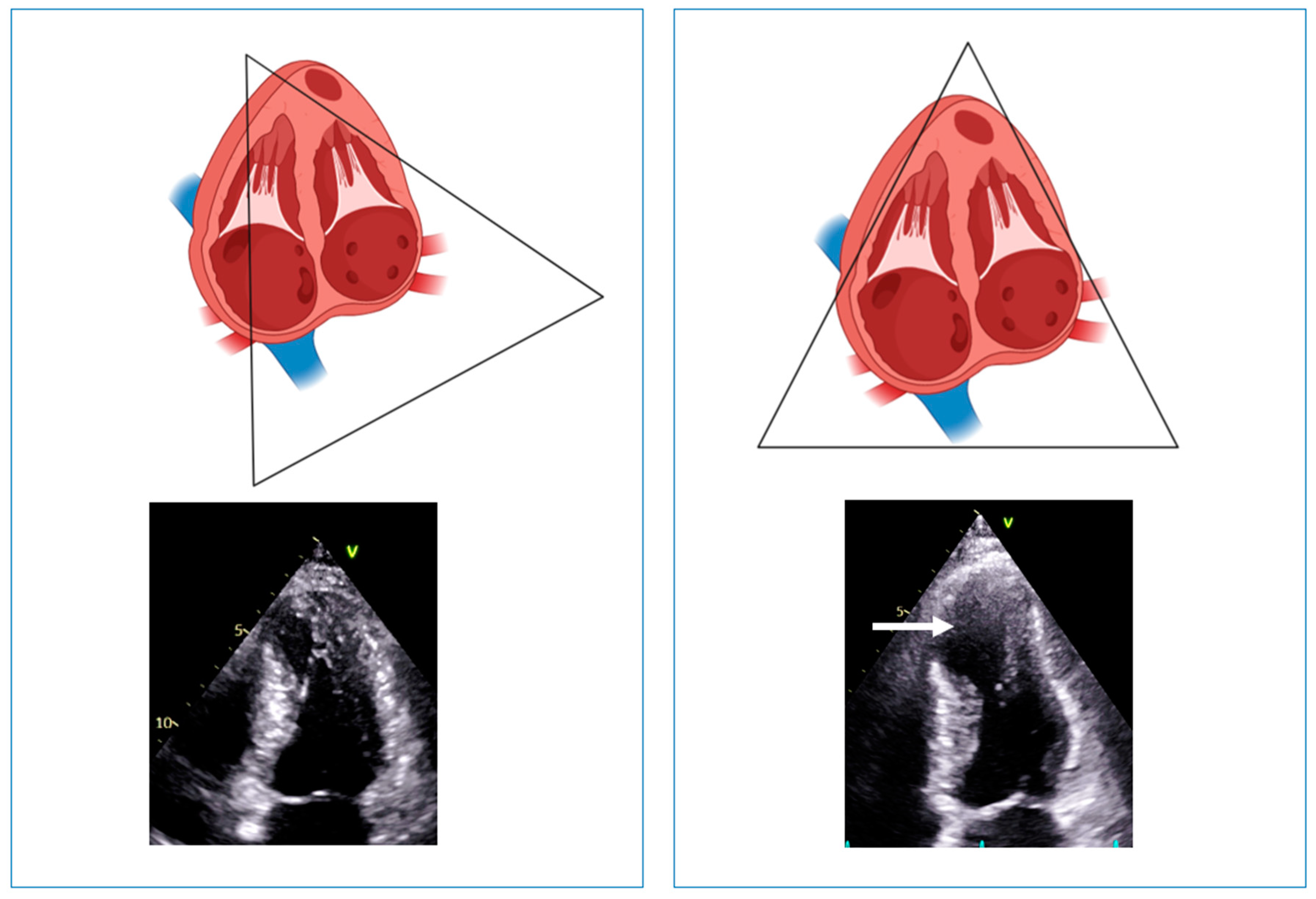 Diagnostics | Free Full-Text | Diagnosis and Clinical Implication of Left Ventricular Aneurysm ...