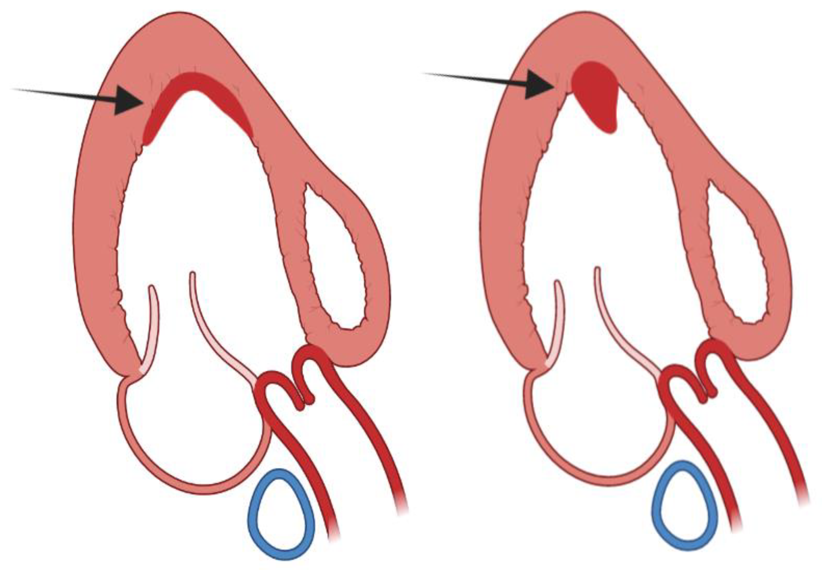 Diagnostics | Free Full-Text | Diagnosis and Clinical Implication of Left Ventricular Aneurysm ...