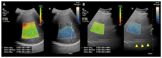 Non-Invasive Imaging Methods to Evaluate Non-Alcoholic Fatty Liver ...