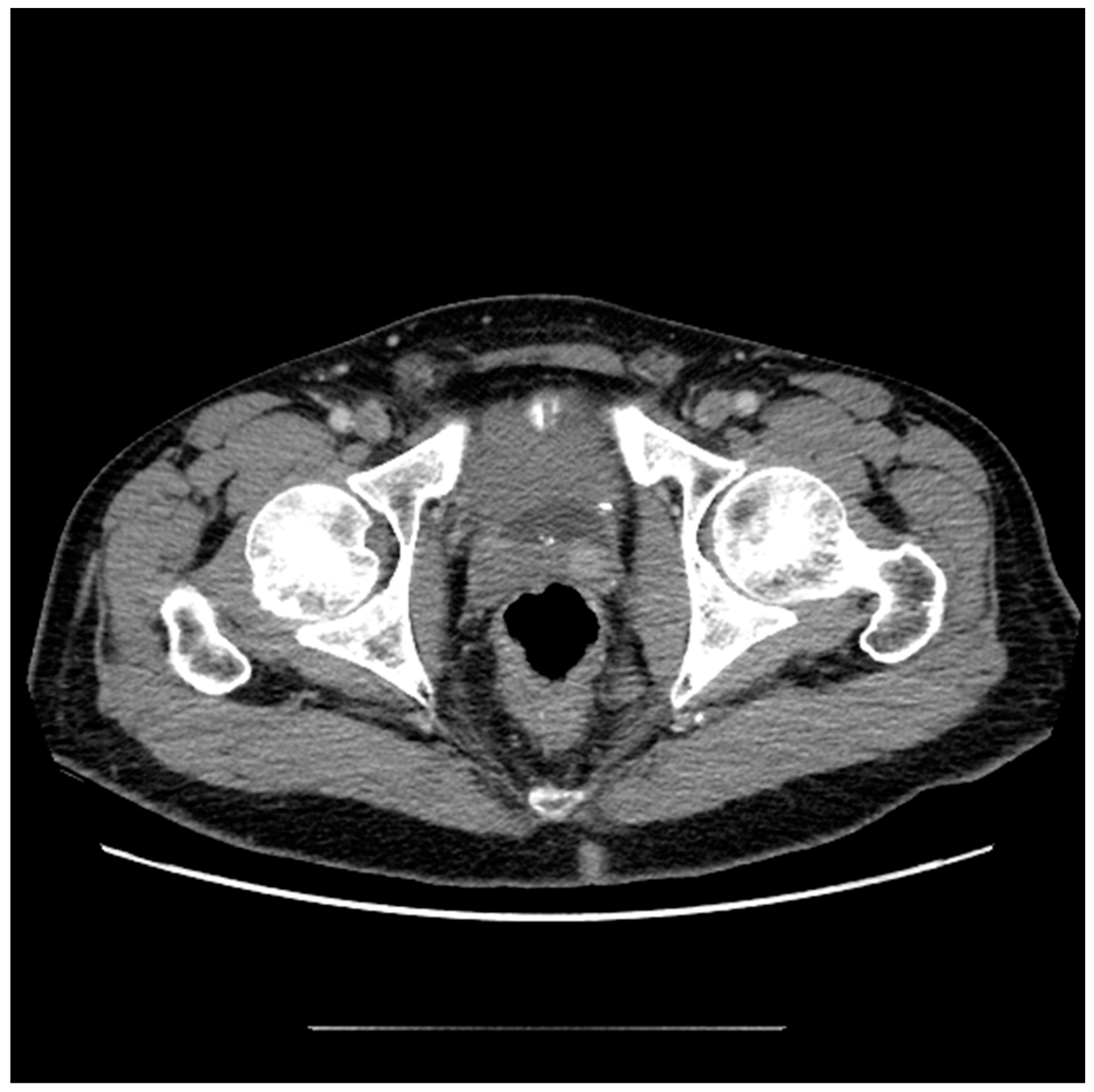 Benign Prostatic Hypertrophy Ultrasound