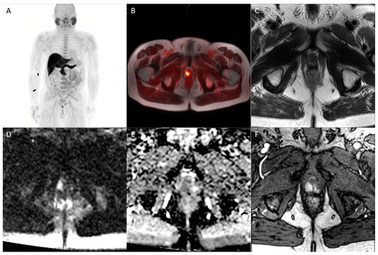 Contemporary Review of Multimodality Imaging of the Prostate Gland