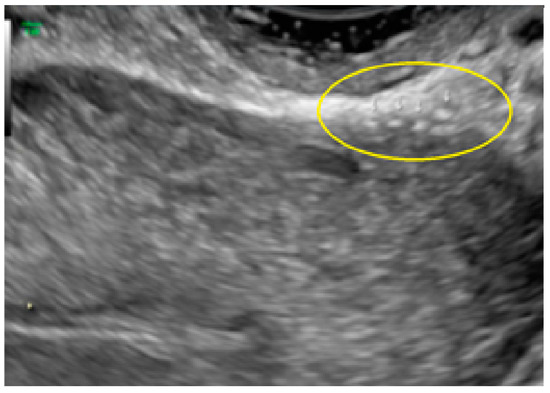 Superficial Endometriosis at Ultrasound Examination—A Diagnostic ...