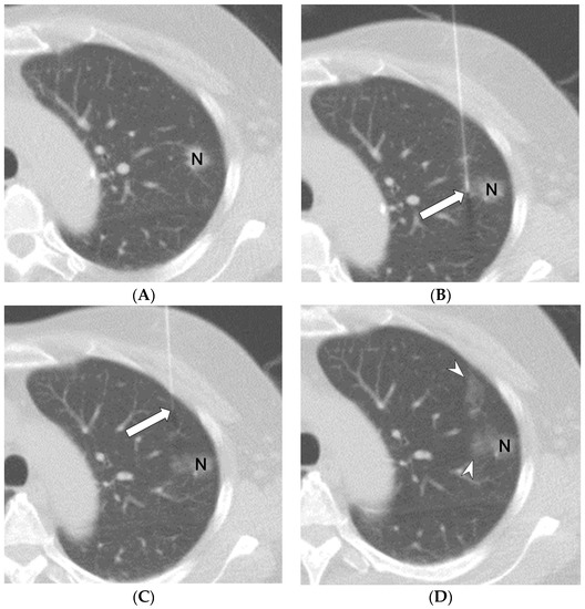 Complications during CT-Guided Lung Nodule Localization: Impact of Needle Insertion Depth and ...