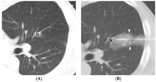 Complications during CT-Guided Lung Nodule Localization: Impact of ...