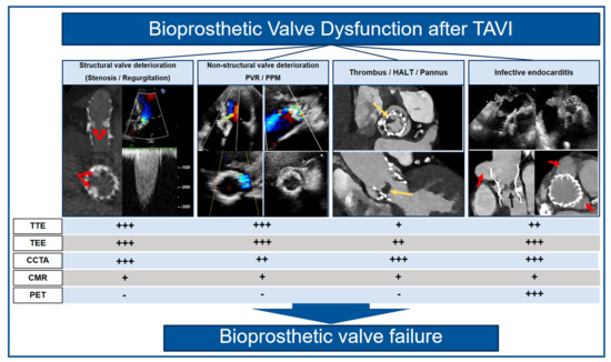 Diagnostics | Free Full-Text | Imaging of Bioprosthetic Valve Dysfunction after Transcatheter ...
