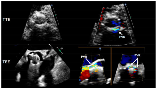 Diagnostics | Free Full-Text | Imaging of Bioprosthetic Valve Dysfunction after Transcatheter ...