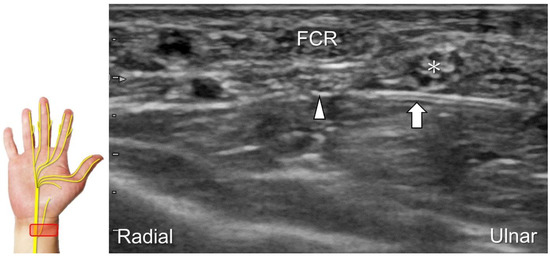 Ultrasound Imaging and Guidance for Distal Peripheral Nerve Pathologies ...
